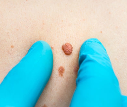 Blogs: Cherry Angioma Removal | Skin Deep Laser Services