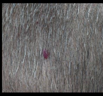 Cherry Angioma Removal (Red Moles) Before and After