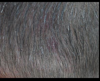Cherry Angioma Removal (Red Moles) Before and After