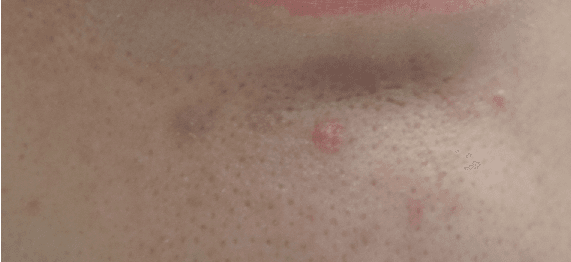 Cherry Angioma Removal (Red Moles) Before and After