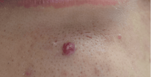 Cherry Angioma Removal (Red Moles) Before and After
