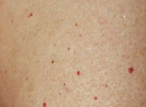 Cherry Angioma Removal (Red Moles) Before and After