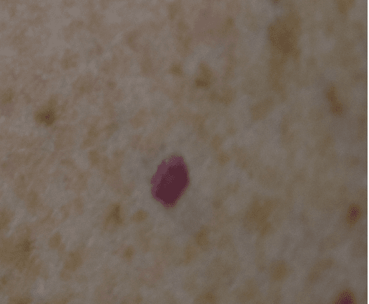 Cherry Angioma Removal (Red Moles) Before and After