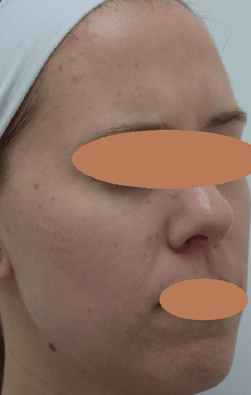 Scar Revision Before And After